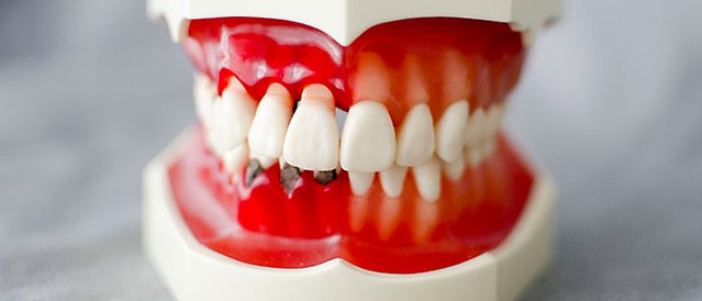 Parodontit och BMI - finns det ett samband? - Forskning - Jönköping ...